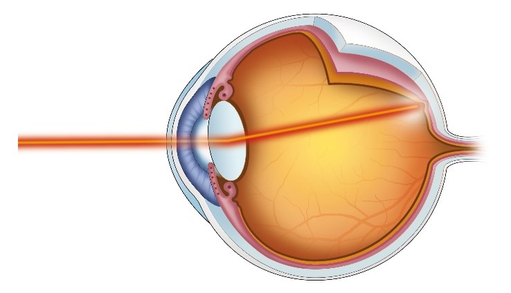 Retinal Laser Treatment Baltimore - Retinal Surgeon Pikesville