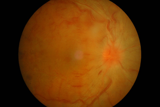Retinal Vein Occlusion Symptoms & Treatment in Baltimore & Catonsville