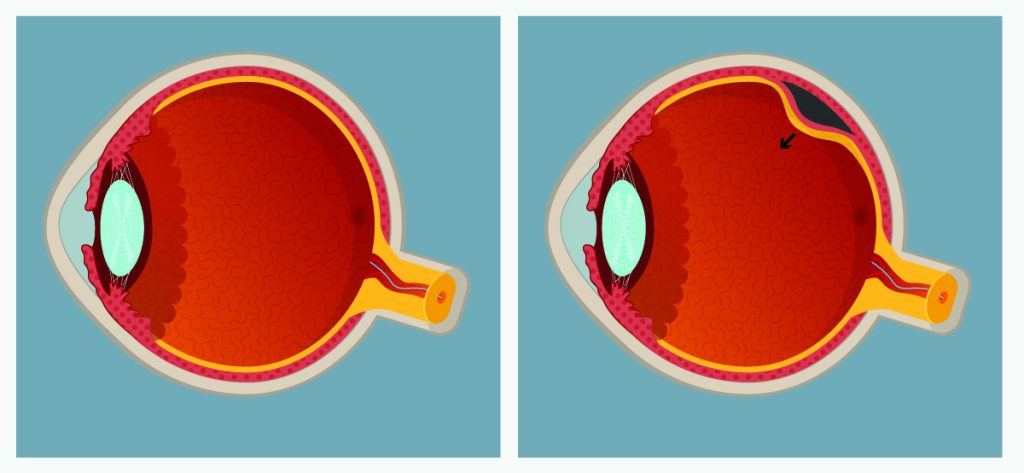 What to Expect During Recovery After a Retinal Detachment