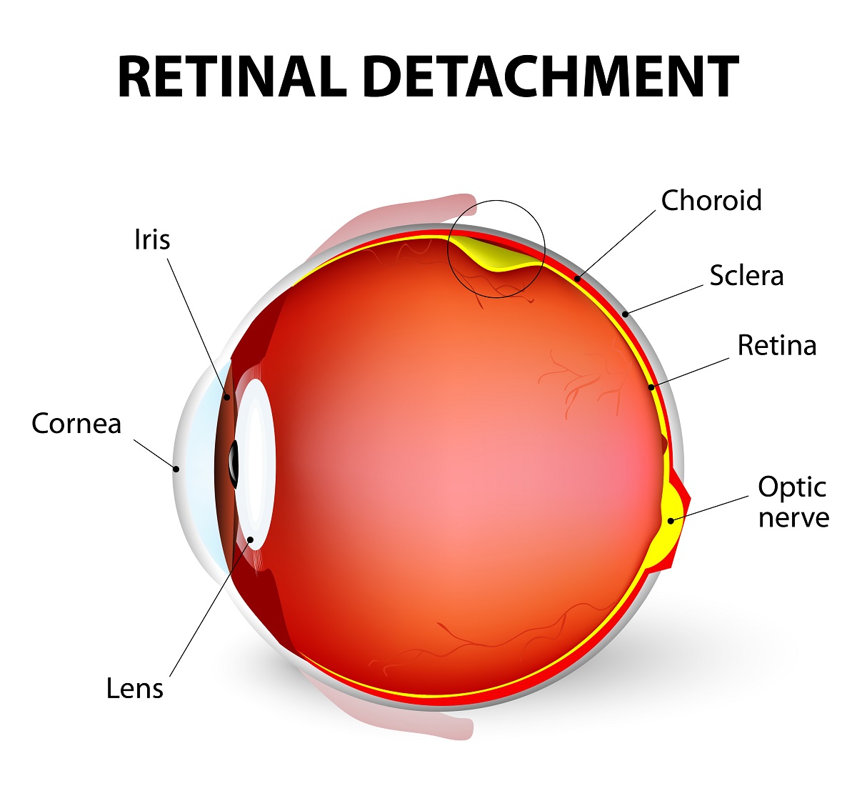 Know Early Warning Signs of Retinal Detachment | Elman Retina Group
